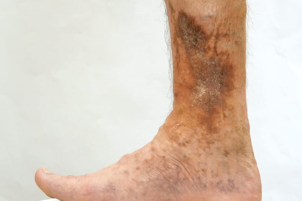 Venous Ulcer Condition and Treatment: A Comprehensive Guide | Peak Vein ...